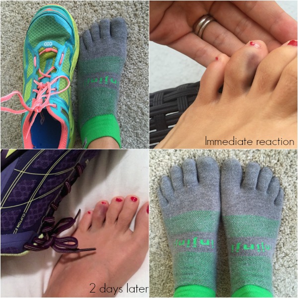 Can You Run With a Broken Toe? What About a Sprained Toe?