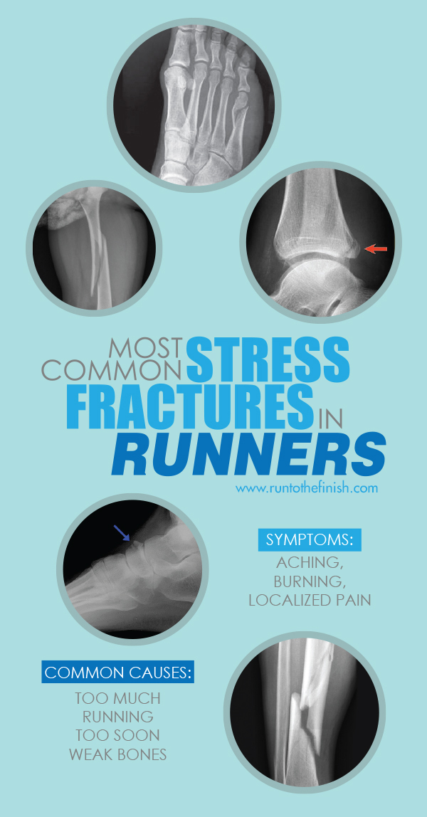 7 Running After Stress Fracture Guidelines (W/ an Athletic Trainer)