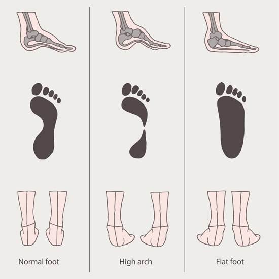 8 Exercises and Tips for Running With Flat Feet (Video)