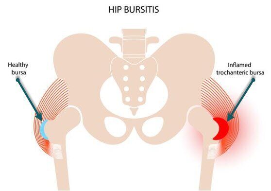 9 Tips to Prevent and Treat Hip Bursitis for Runners (from a PT)